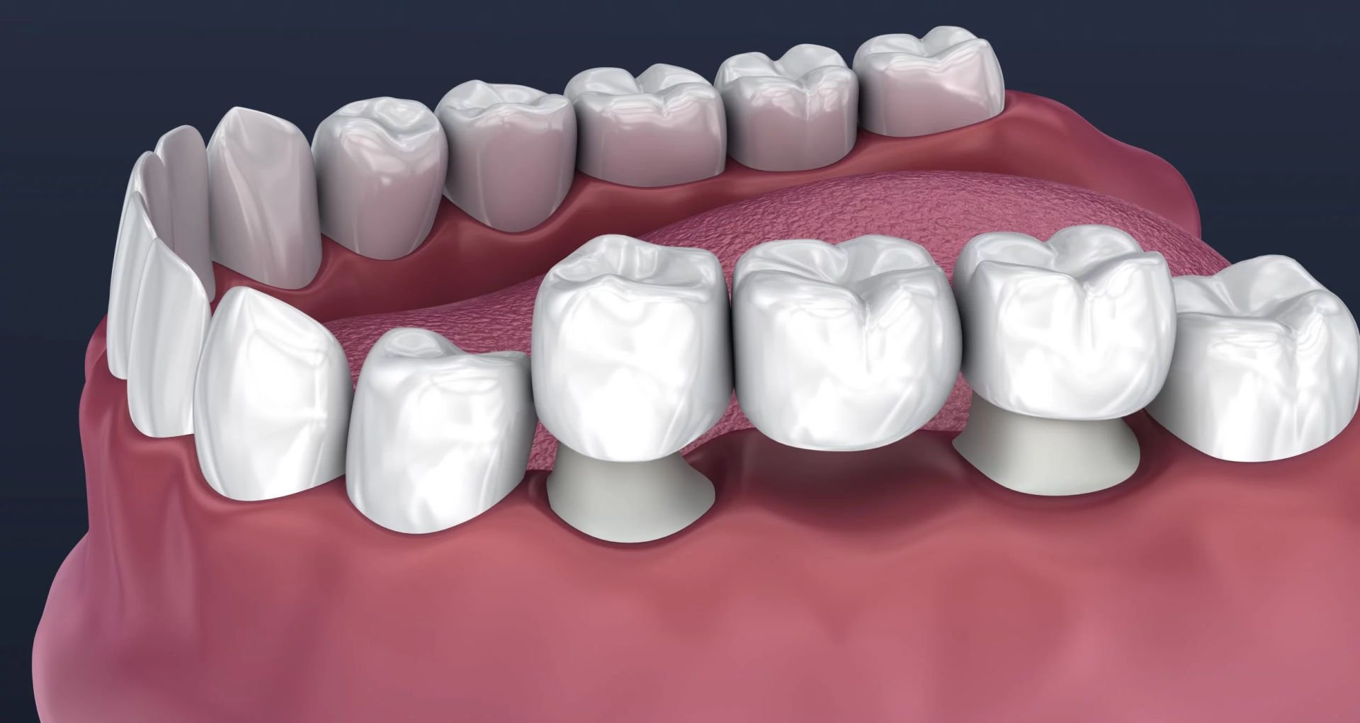 Dental Bridges | ENAMEL REPUBLIC | Dentist Kitchener